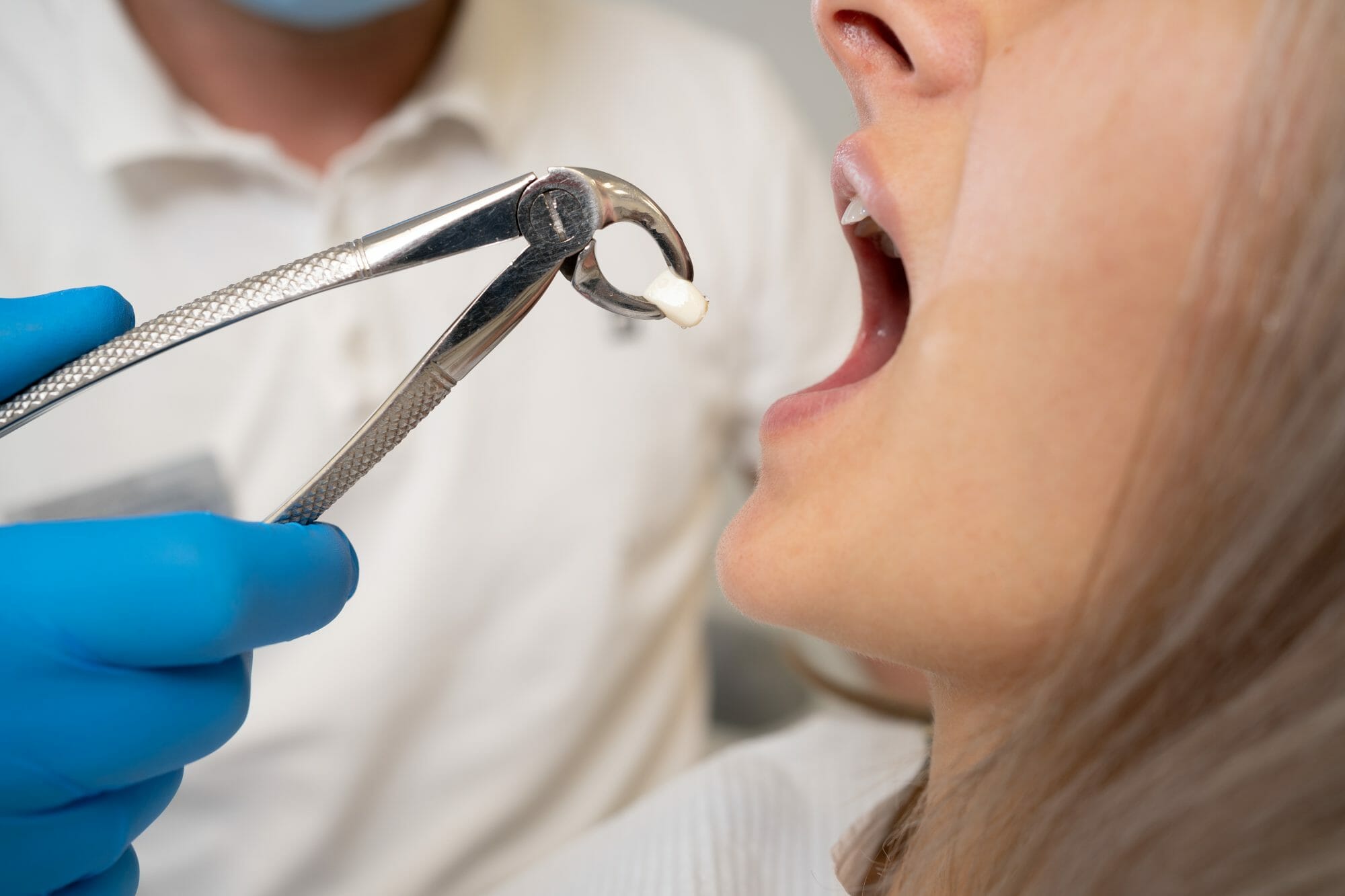 Tooth Extraction Recovery: Valuable Tips for Smooth Healing Tooth Extraction Recovery: Valuable Tips for Smooth Healing