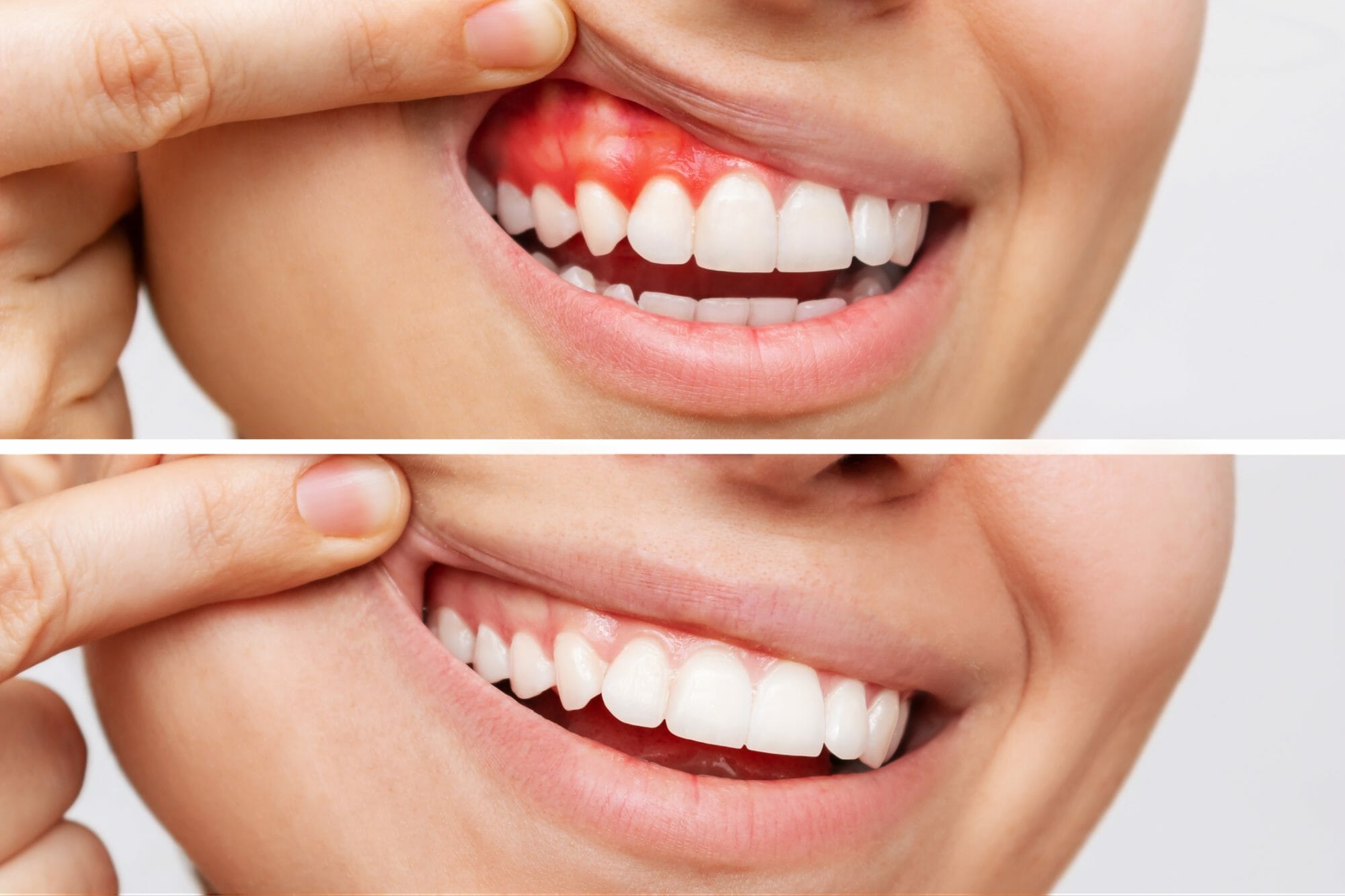 Treating Periodontal Disease All You Need To Know